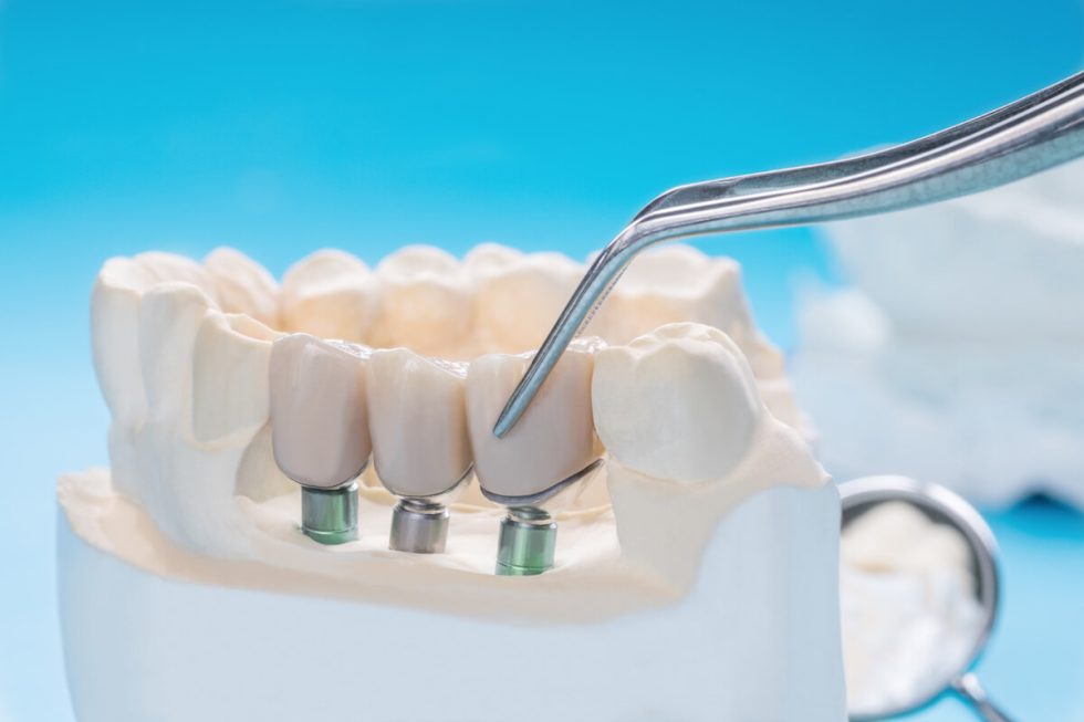 Dental Crowns vs Bridges: A Comparison of Restorative Options - Kreativ ...